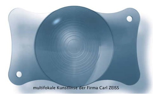 SLK Kliniken: Intraocularlinsen